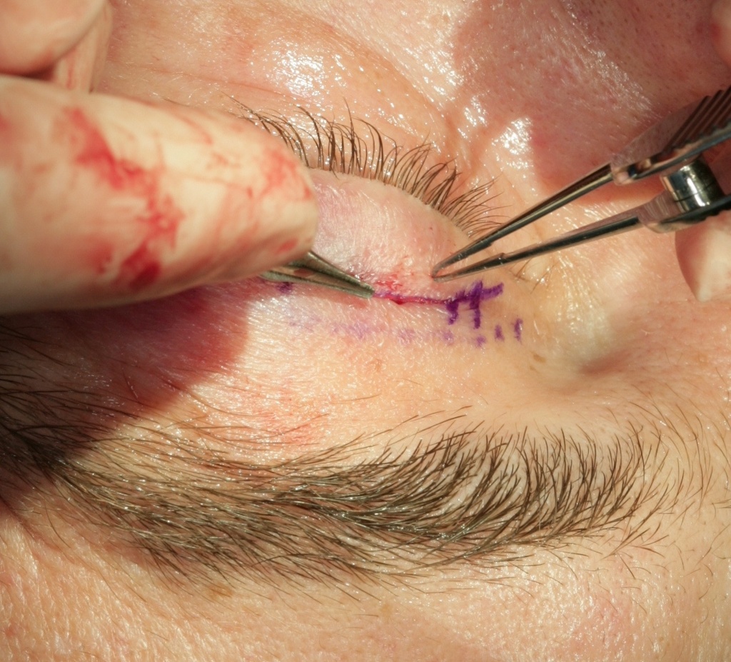 Platinum-Gold Eyelid Weighting | Iowa Head and Neck Protocols - Carver ...