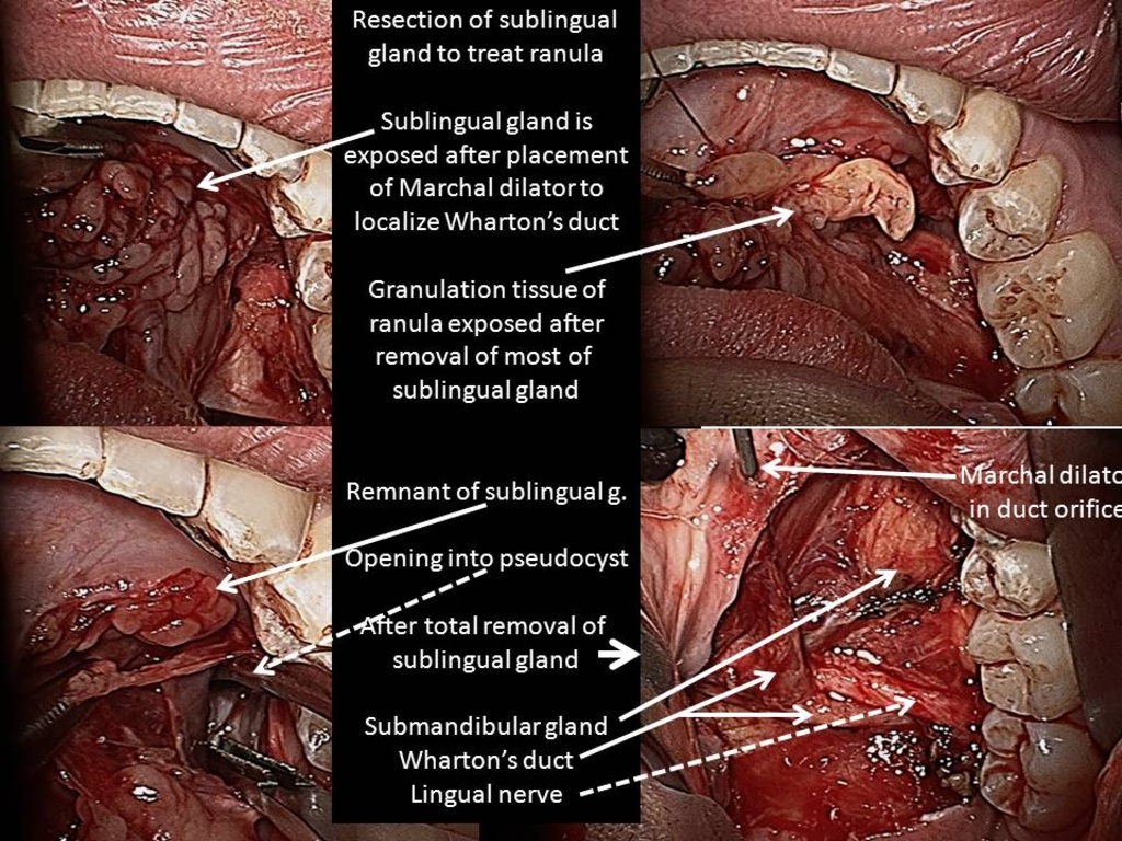 Plunging Ranula Transoral Resection (Sublingual Gland) Aided With ...
