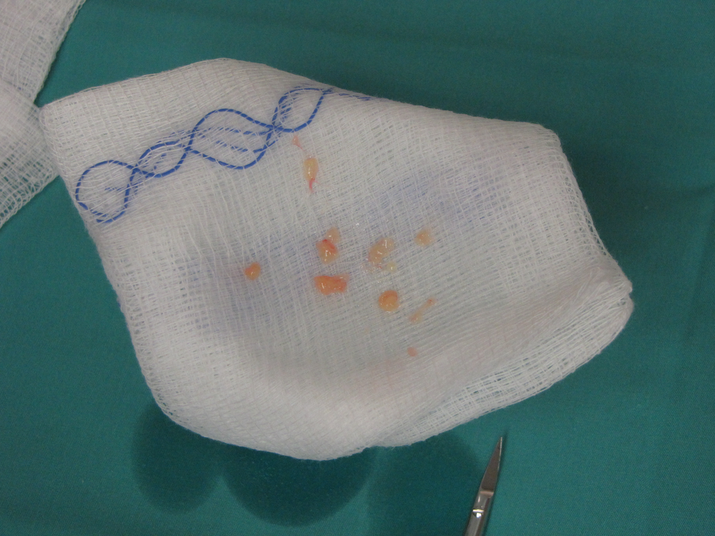 Laryngeal Fat Injection for Vocal Cord Paralysis and Glottic ...