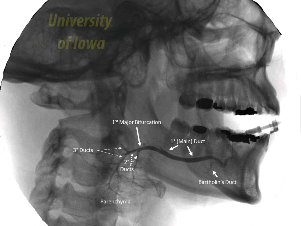 Classification of Salivary Duct Stenosis (Parotid Duct Stricture ...