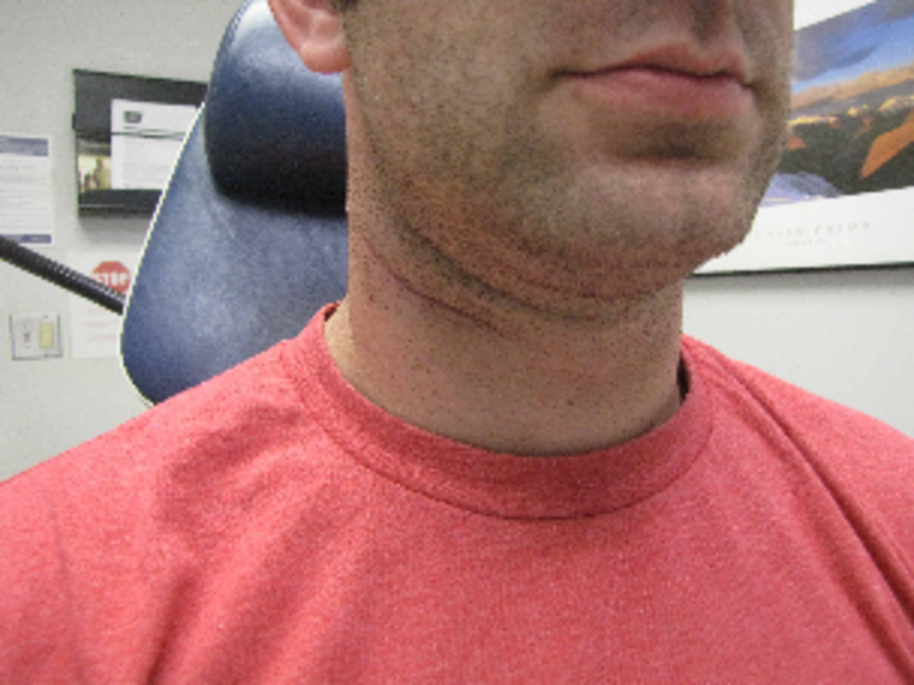 Salivary Gland Anatomic Anomalies and Foreign Bodies Lecture AHNS ...