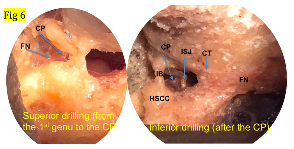 Temporal Bone Anatomy (Cadaveric Dissection) | Iowa Head and Neck ...