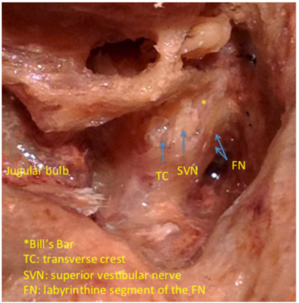 Temporal Bone Anatomy (Cadaveric Dissection) | Iowa Head and Neck ...