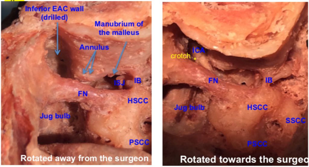 Temporal Bone Anatomy (Cadaveric Dissection) | Iowa Head and Neck ...