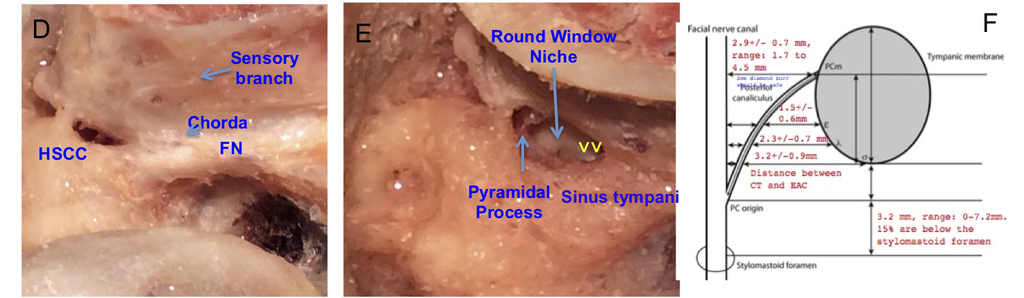 Temporal Bone Anatomy (Cadaveric Dissection) | Iowa Head and Neck ...