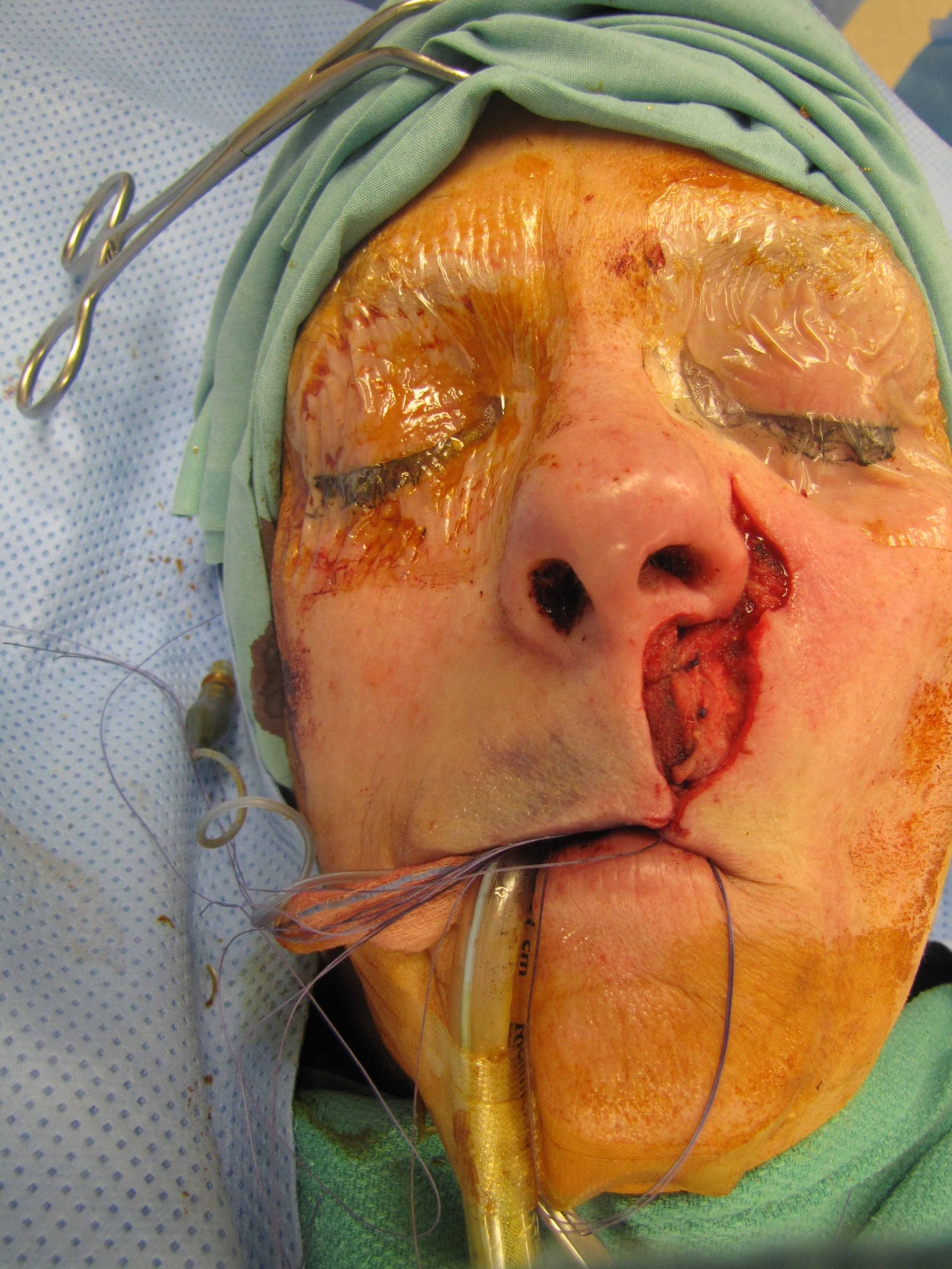 Lip Reconstruction Peri-alar Crescentic Advancement Flap - Clinical ...
