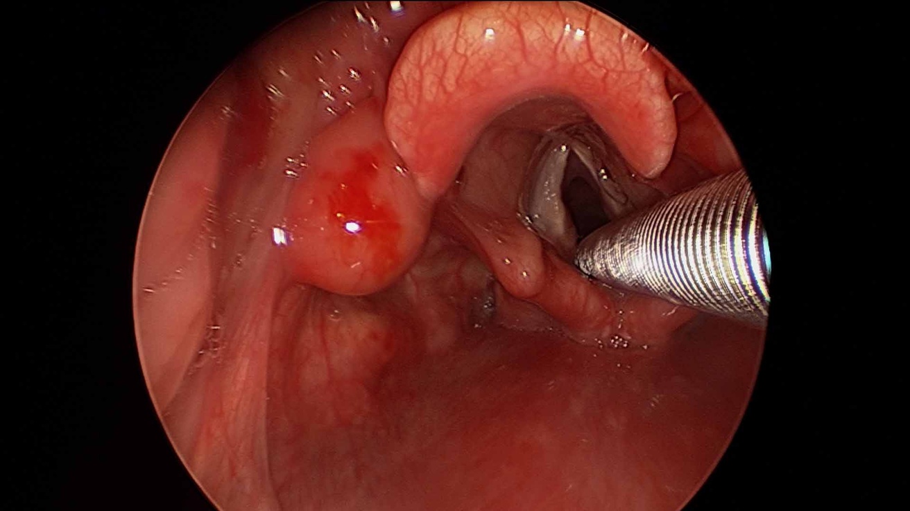 Vallecular Cyst | Iowa Head and Neck Protocols - Carver College of ...