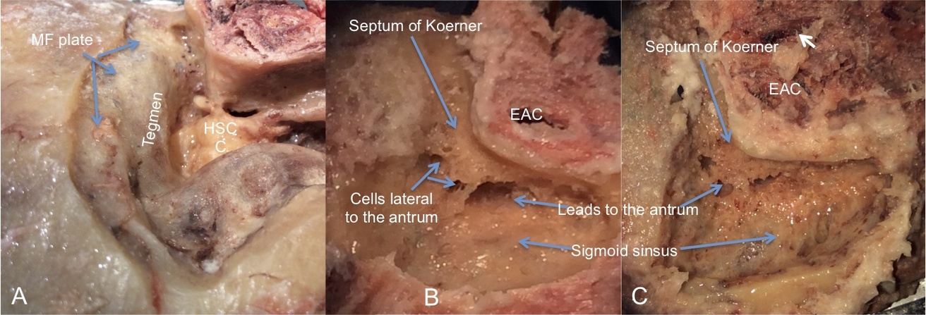 Temporal Bone Anatomy (Cadaveric Dissection) | Iowa Head and Neck ...
