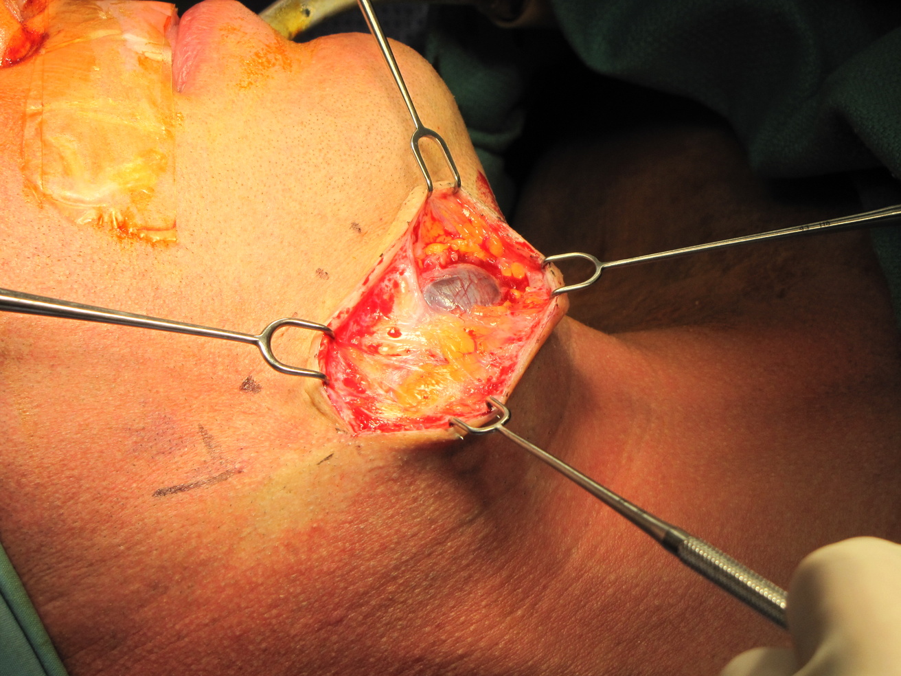 Plunging Ranula - Now Antiquated Treatment | Iowa Head and Neck ...