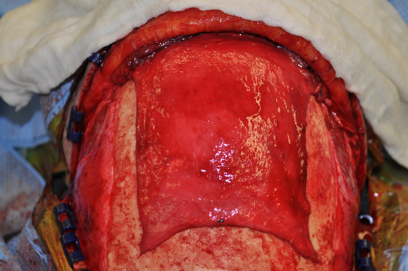 Anterior Pericranial and Galeofrontalis-Pericranial Flaps | Iowa Head ...