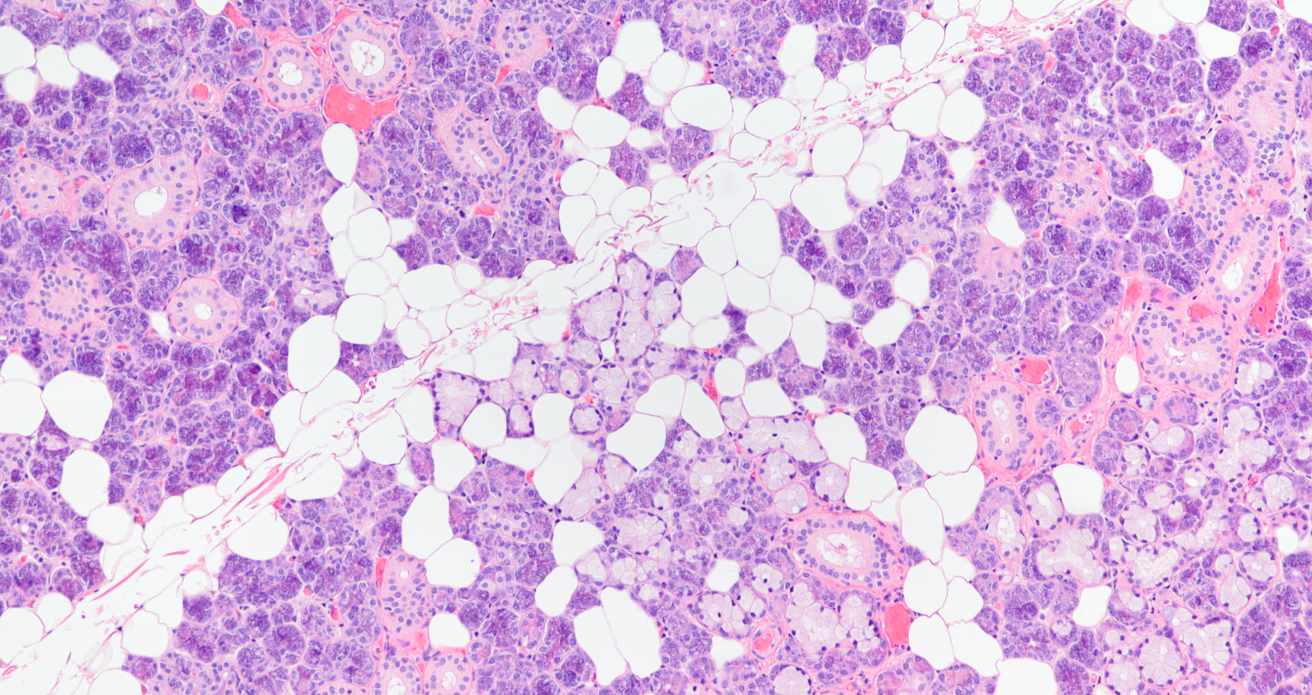 Submandibular Gland Anatomy: The Uncinate Process of the Deep Lobe ...