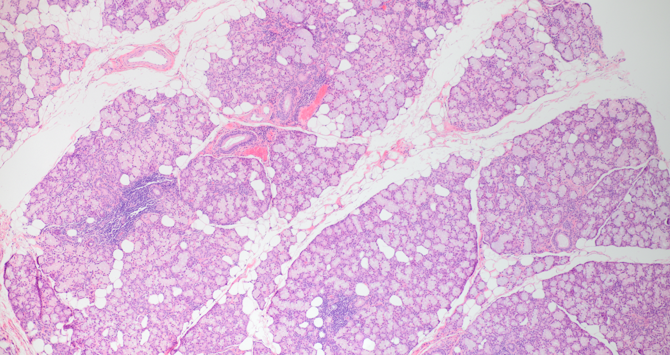 Submandibular Gland Anatomy: The Uncinate Process of the Deep Lobe ...