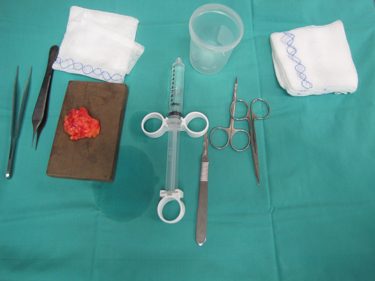 Laryngeal Fat Injection for Vocal Cord Paralysis and Glottic ...