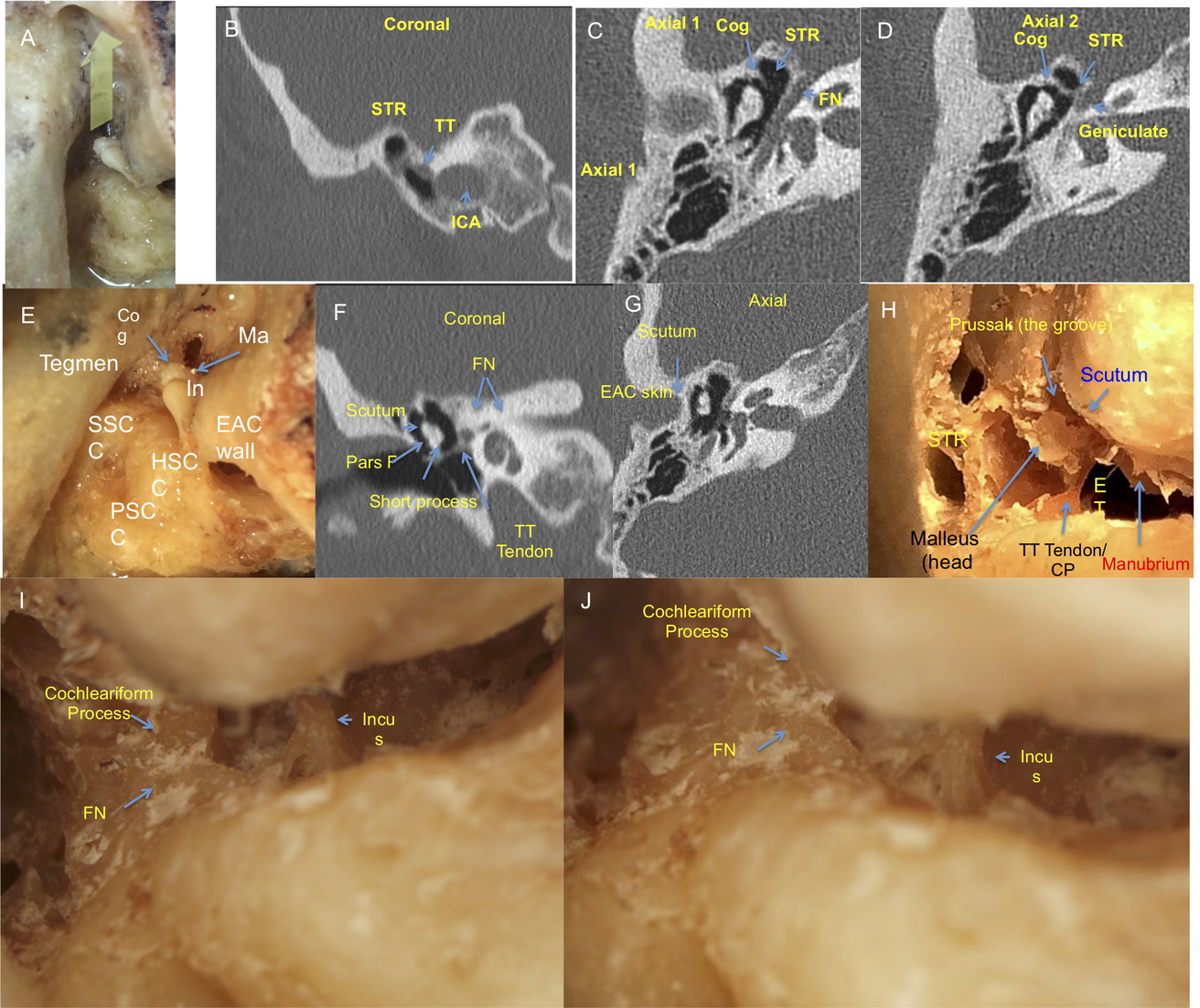 Temporal Bone Anatomy (Cadaveric Dissection) | Iowa Head and Neck ...
