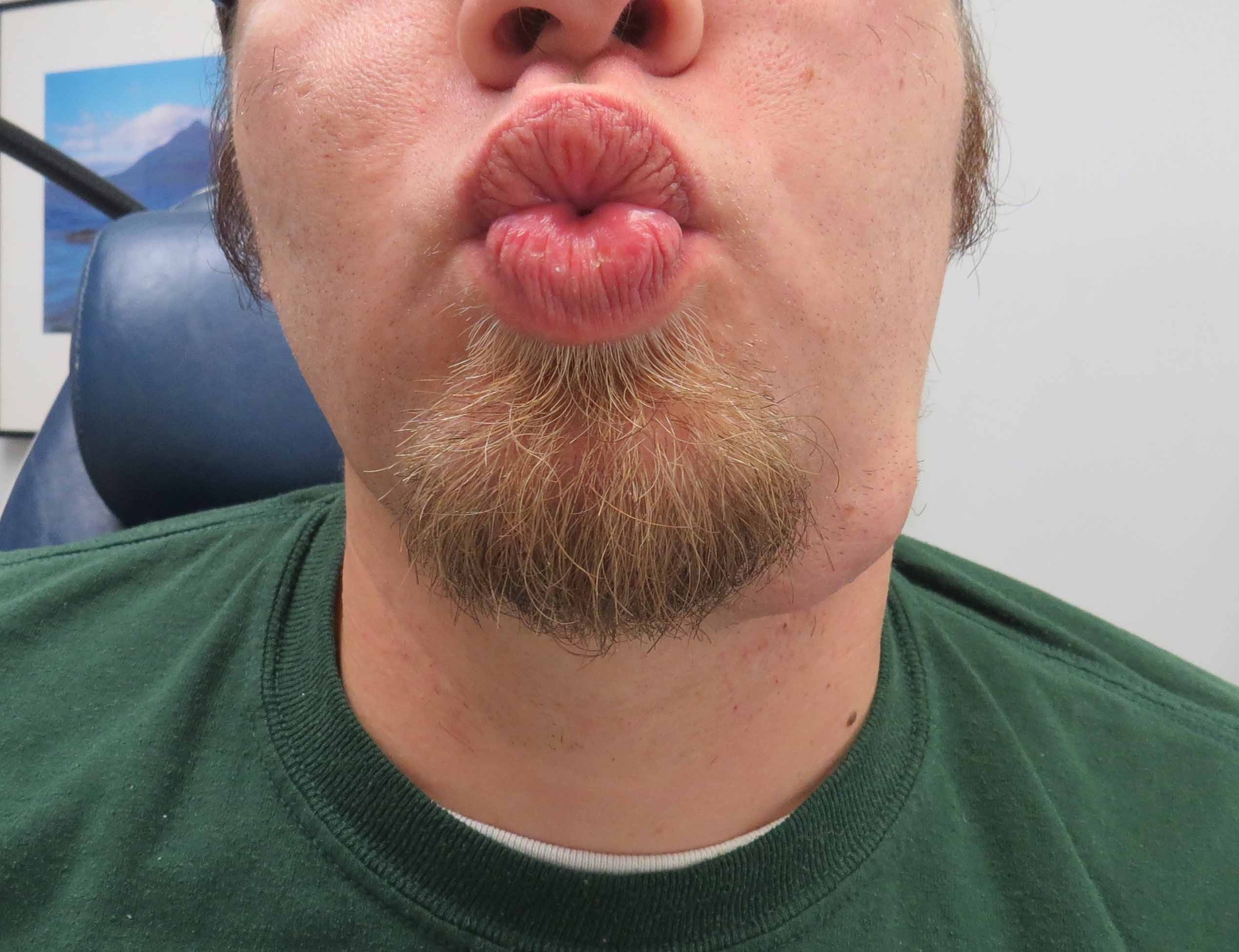 Marginal Mandibular Nerve Weakness (Ramus Mandibularis) - Level I Neck ...