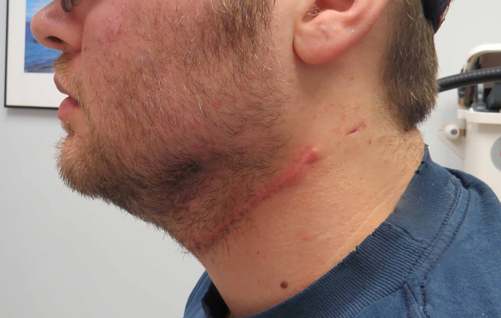 Marginal Mandibular Nerve Weakness (Ramus Mandibularis) - Level I Neck ...