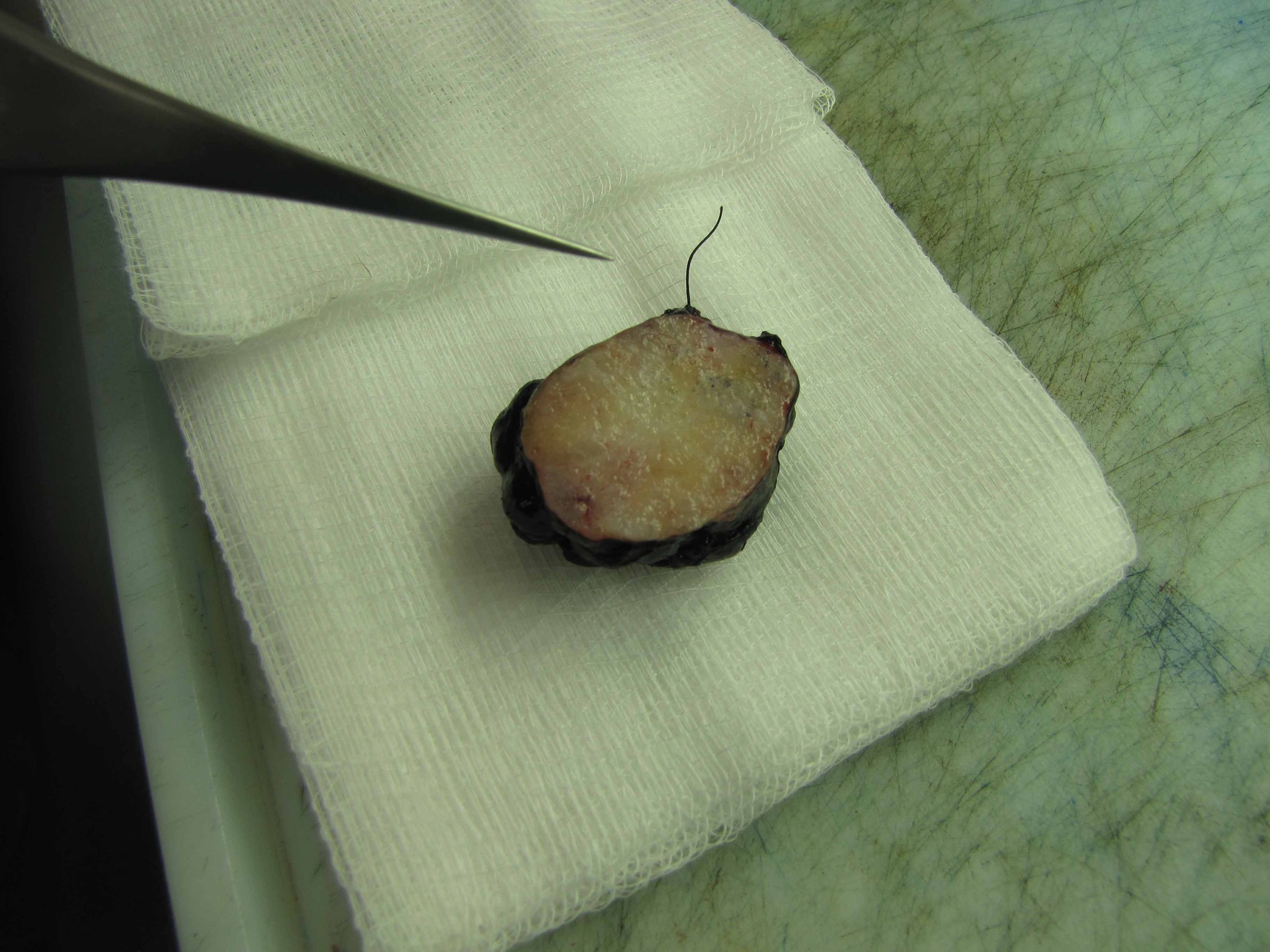 Deep Lobe Parotid Tumor/Parapharyngeal Space Pleomorphic Adenoma ...