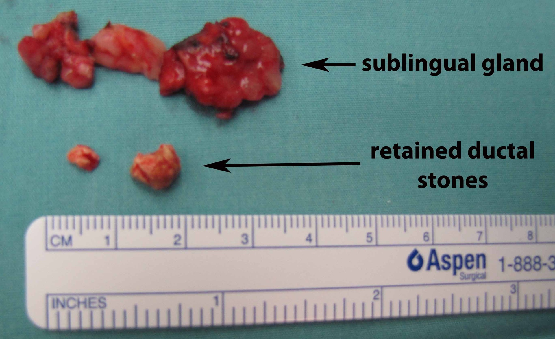 Retained Submandibular Stone After Submandibular Gland Resection with ...