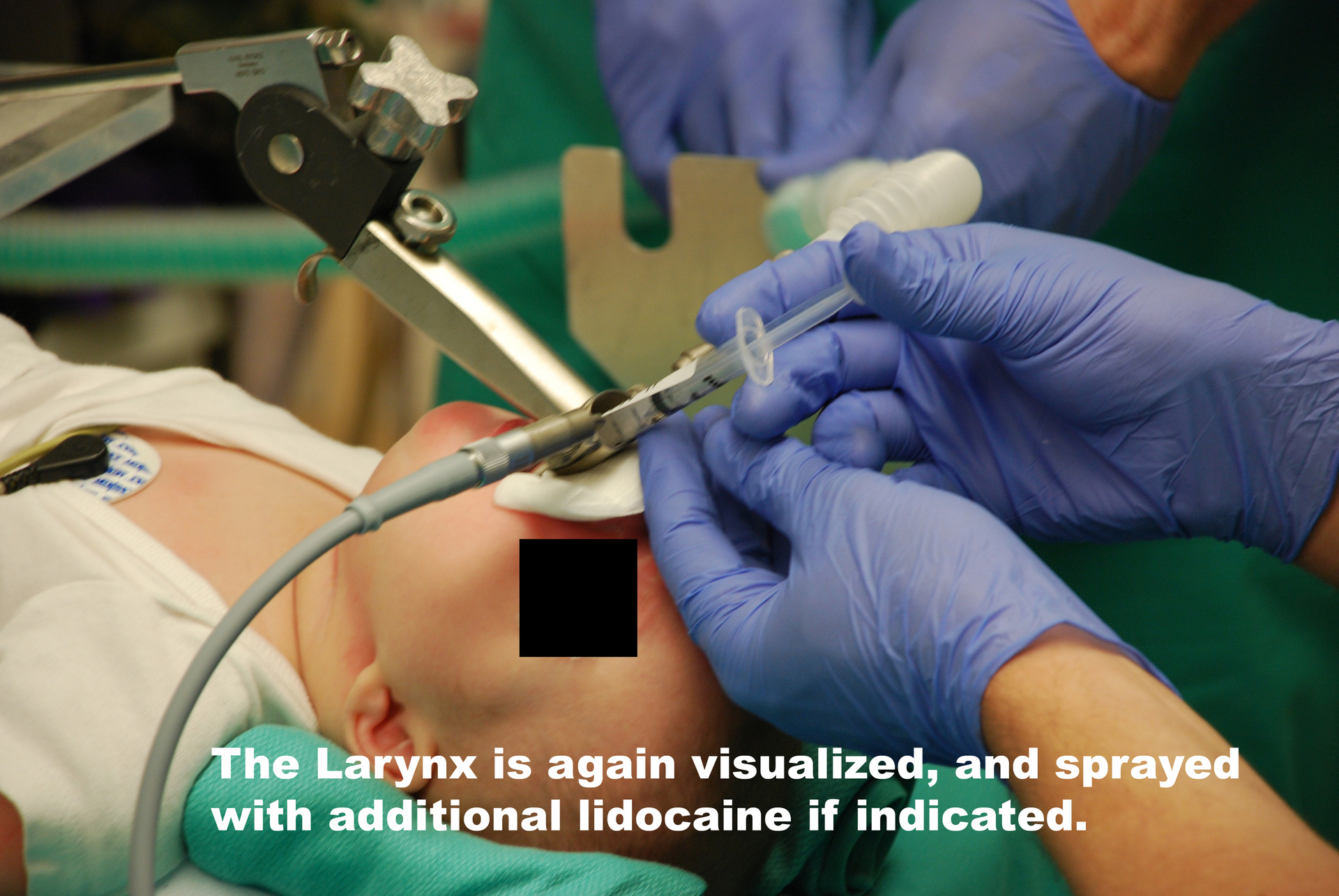 Pediatric Direct Laryngoscopy | Iowa Head and Neck Protocols - Carver ...