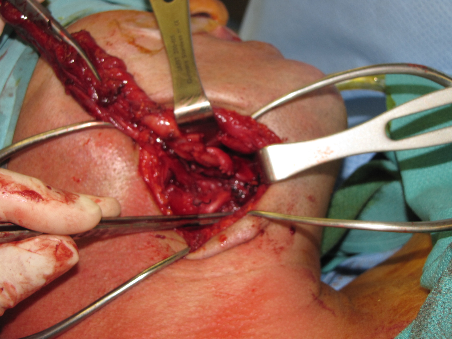 Plunging Ranula - Now Antiquated Treatment | Iowa Head and Neck ...