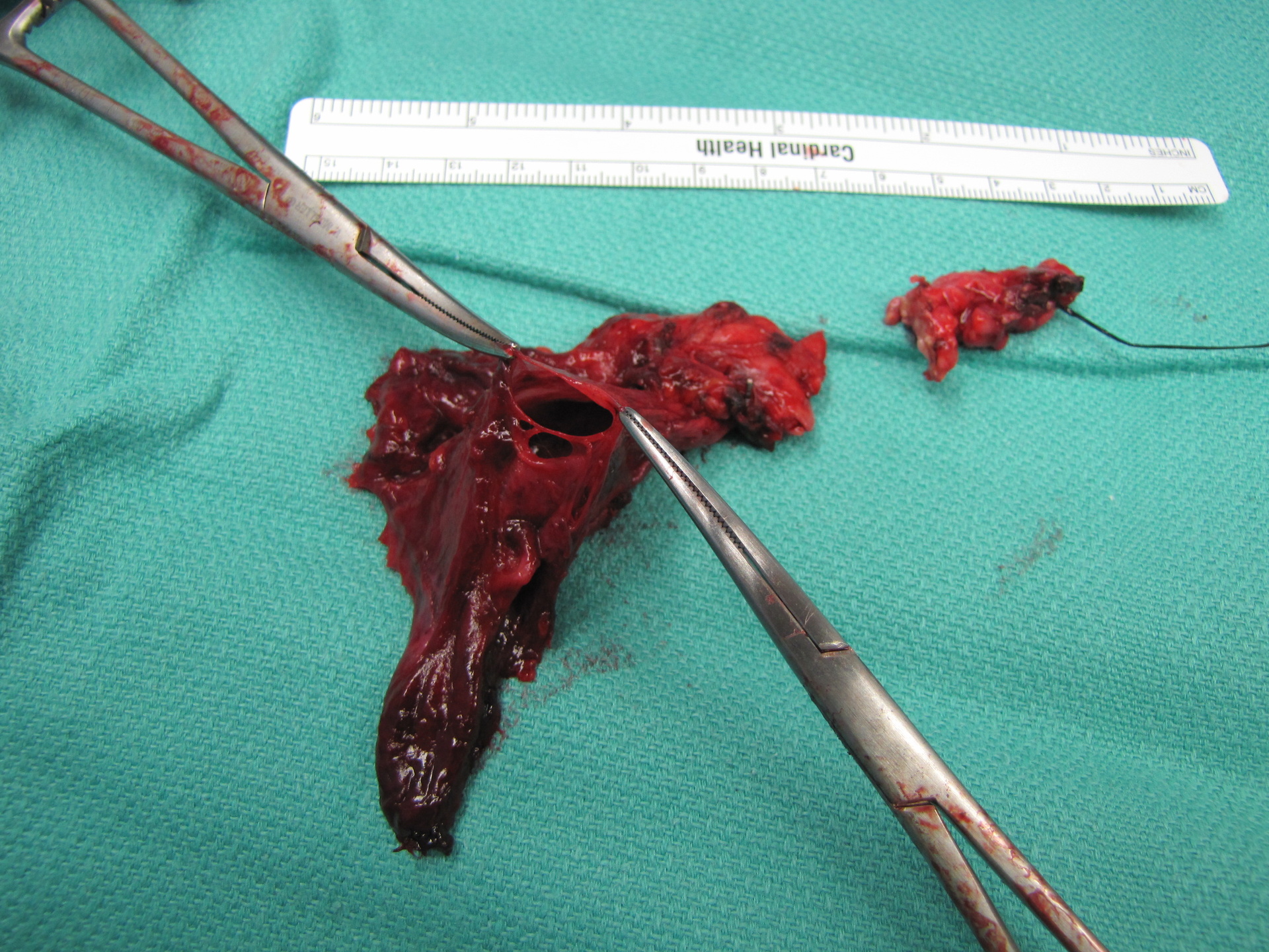 Plunging Ranula - Now Antiquated Treatment | Iowa Head and Neck ...