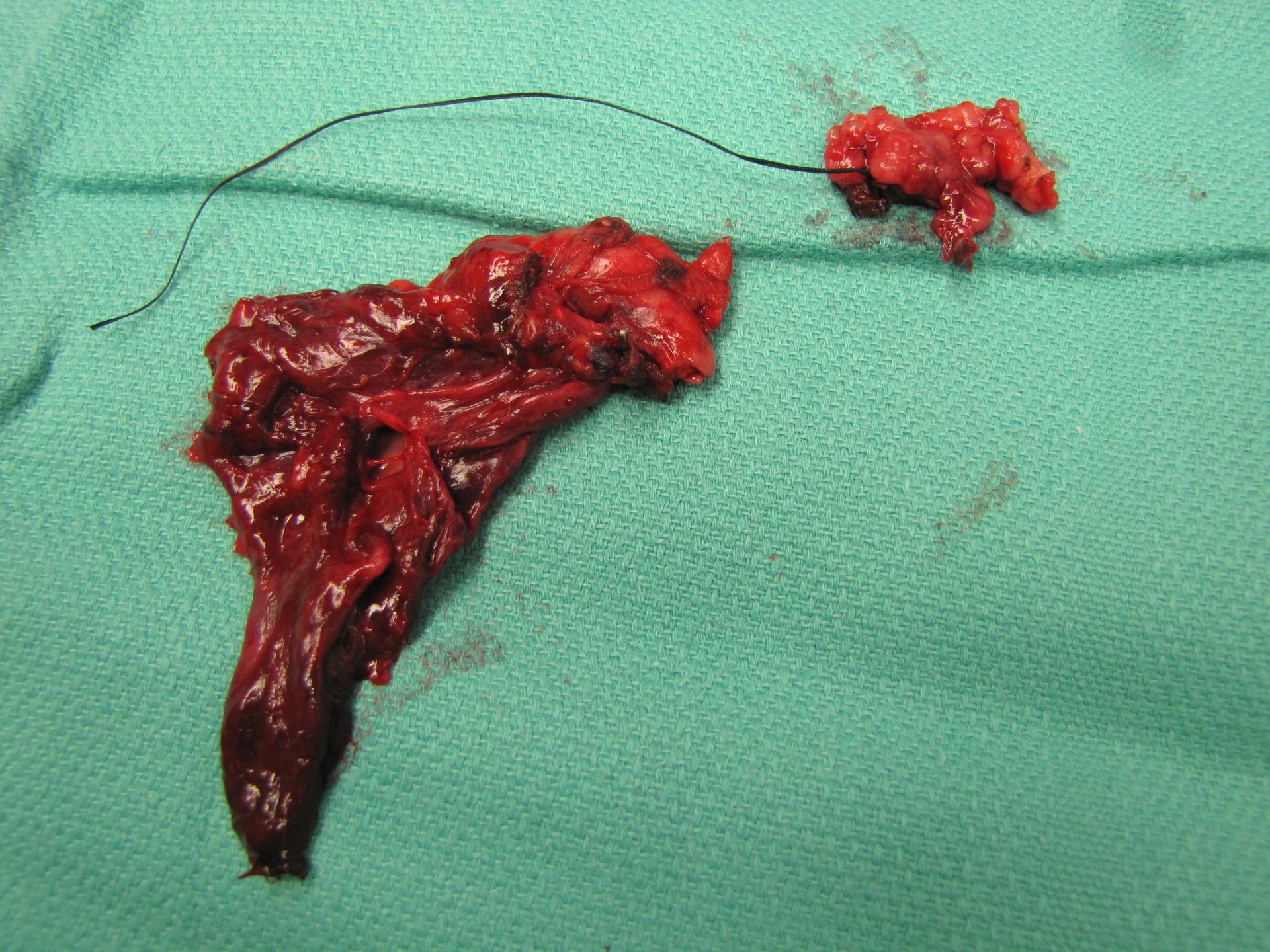 Plunging Ranula - Now Antiquated Treatment | Iowa Head and Neck ...