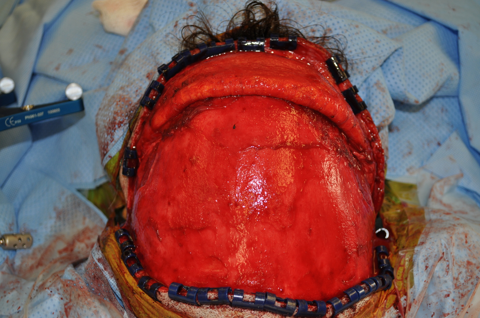 Anterior Pericranial and Galeofrontalis-Pericranial Flaps | Iowa Head ...