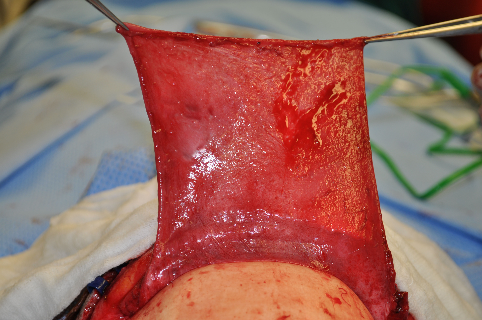 Anterior Pericranial and Galeofrontalis-Pericranial Flaps | Iowa Head ...