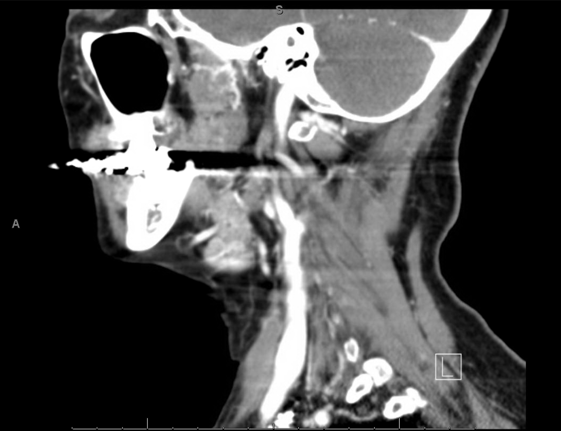 Chronic Submandibular Gland Sialadenitis - Case Example | Iowa Head and ...
