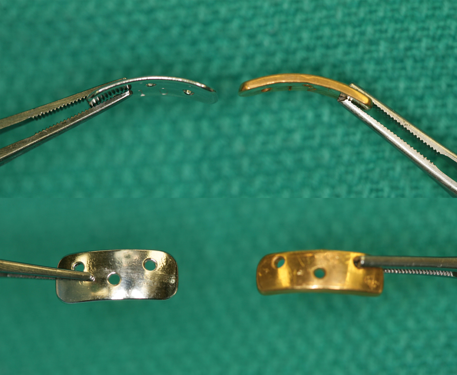 Platinum-Gold Eyelid Weighting | Iowa Head and Neck Protocols - Carver ...