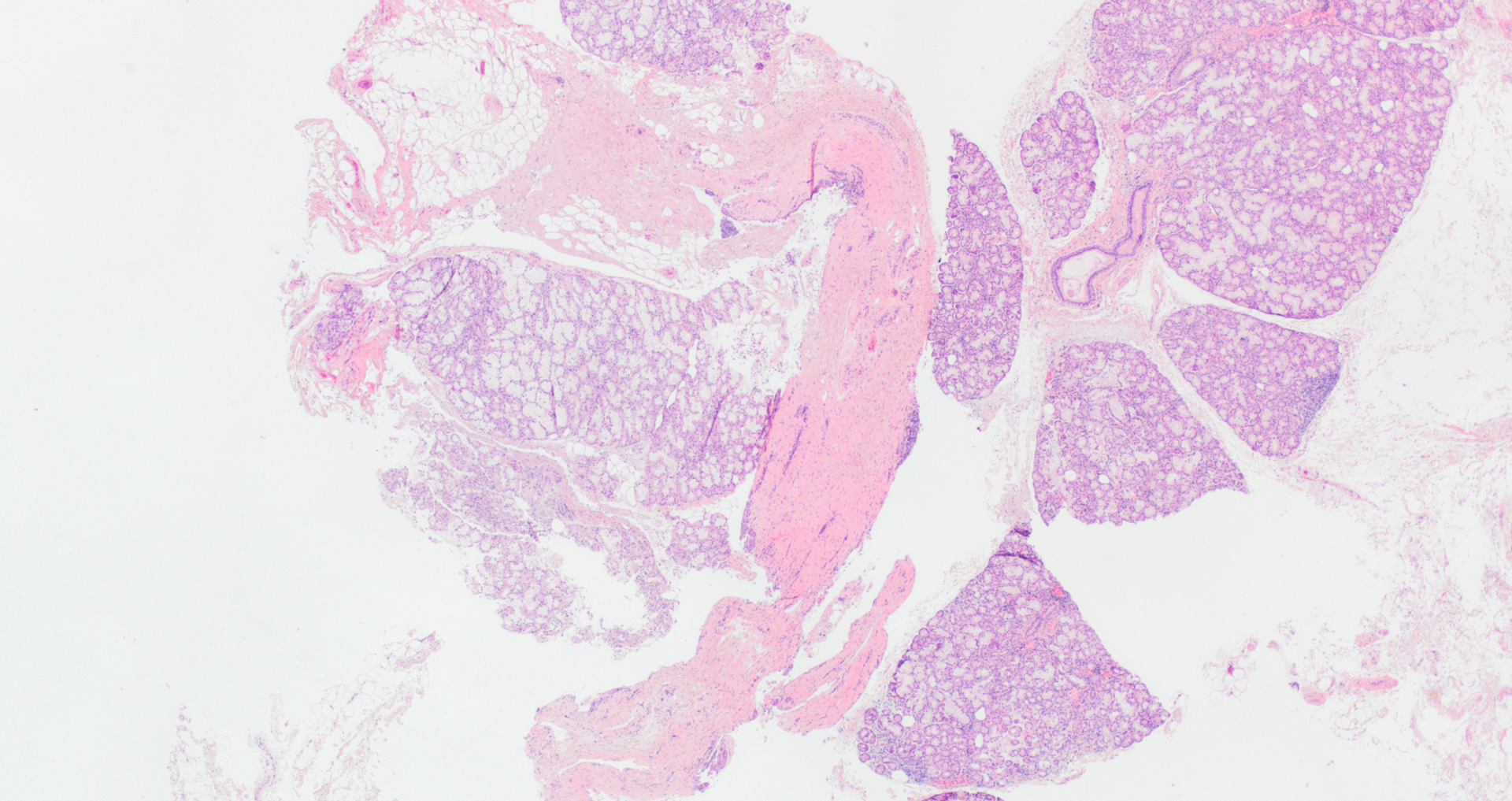 Submandibular Gland Anatomy: The Uncinate Process of the Deep Lobe ...