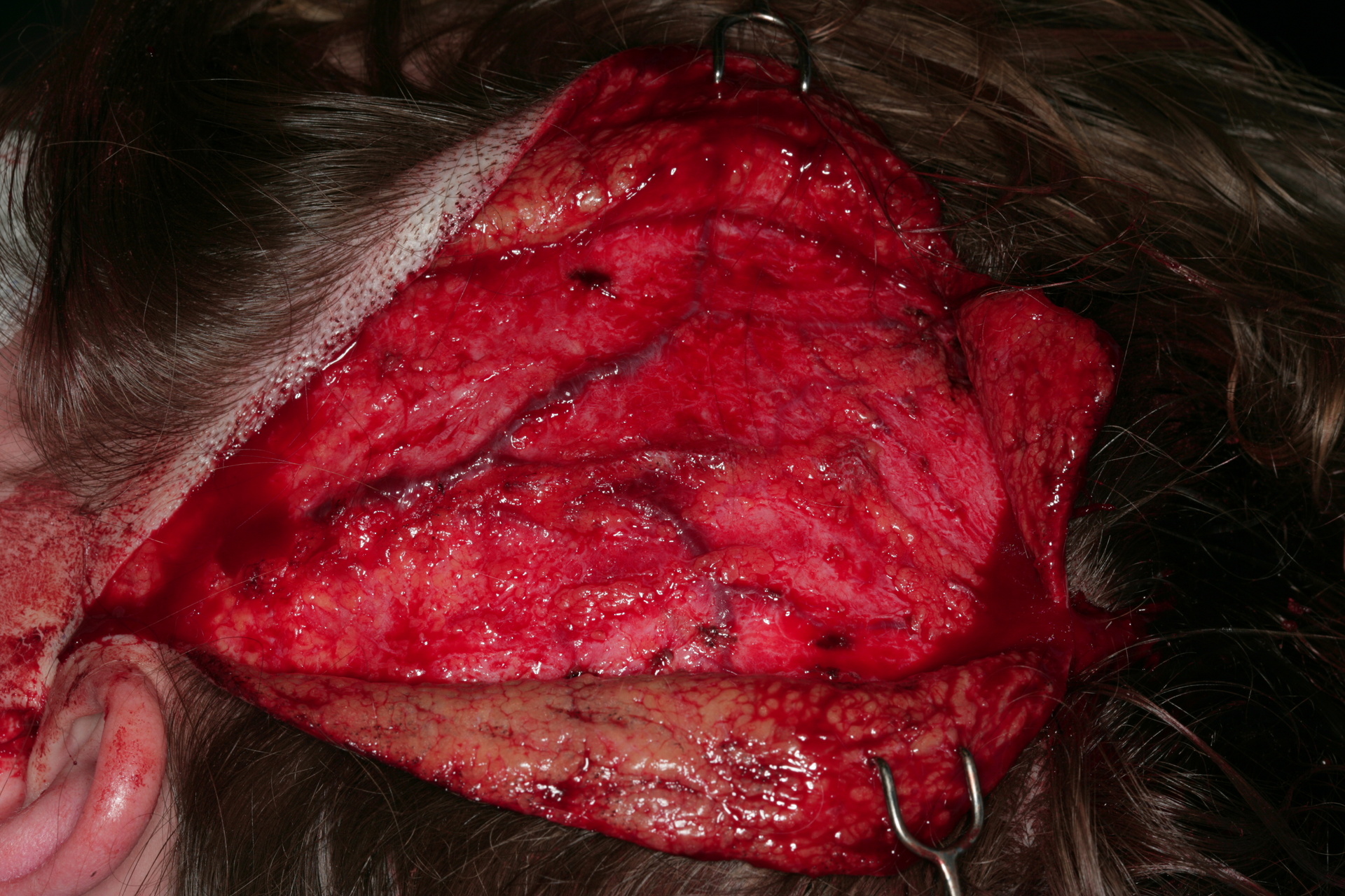 Temporoparietal Fascia Flap | Iowa Head and Neck Protocols - Carver ...