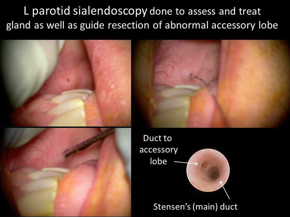 Saccular Cyst of the Larynx with Endoscopic Removal - Case Example ...