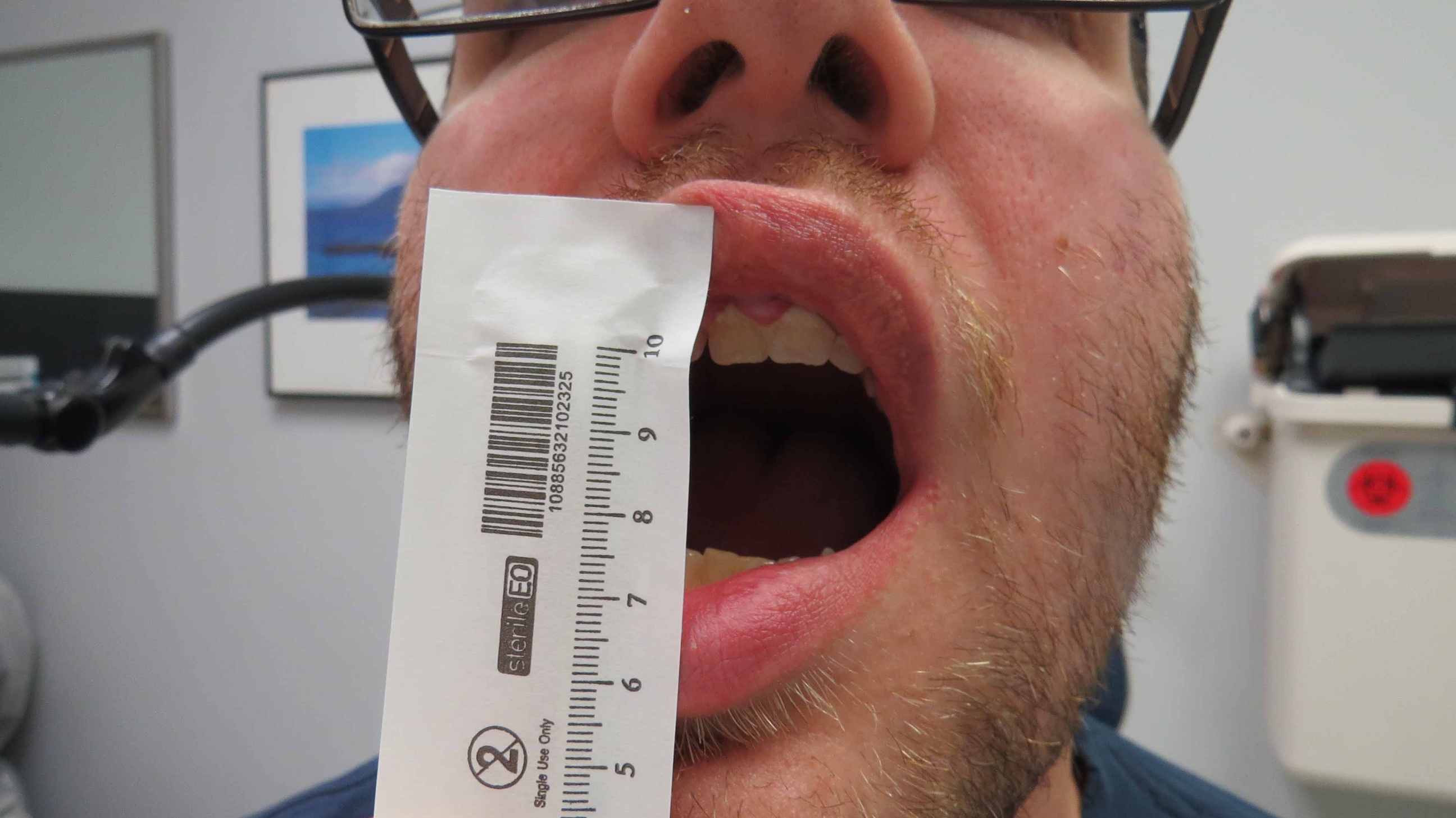 Marginal Mandibular Nerve Weakness (Ramus Mandibularis) - Level I Neck ...
