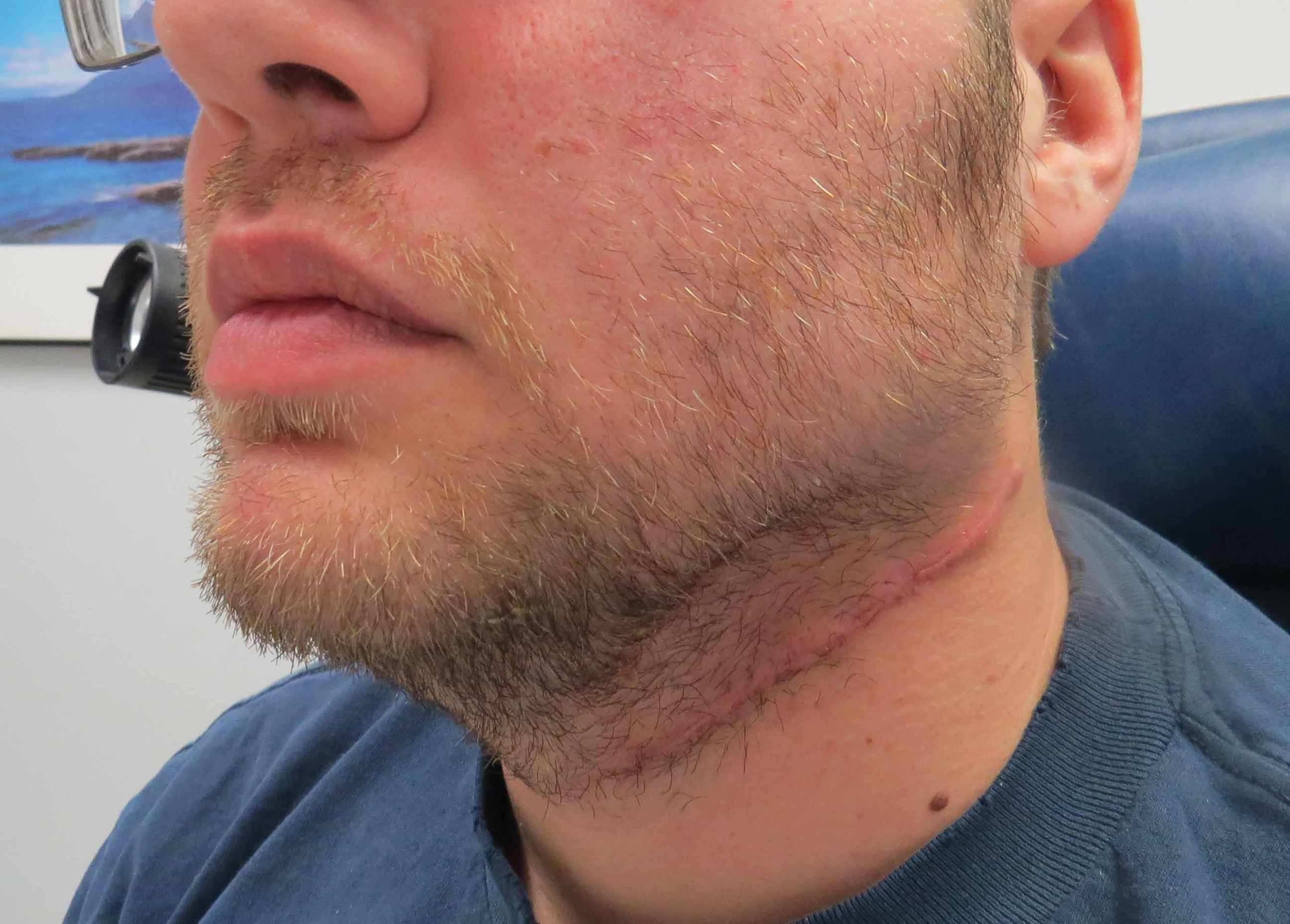 Marginal Mandibular Nerve Weakness (Ramus Mandibularis) - Level I Neck ...