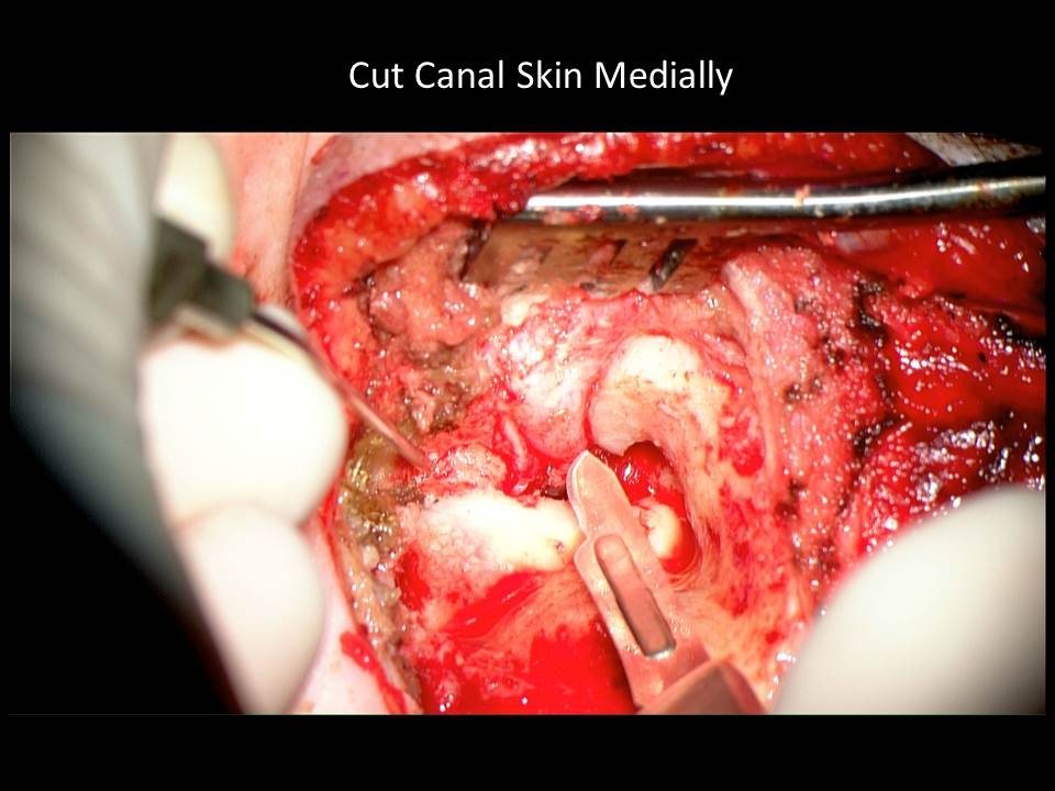 Subtotal Petrosectomy | Iowa Head and Neck Protocols - Carver College ...