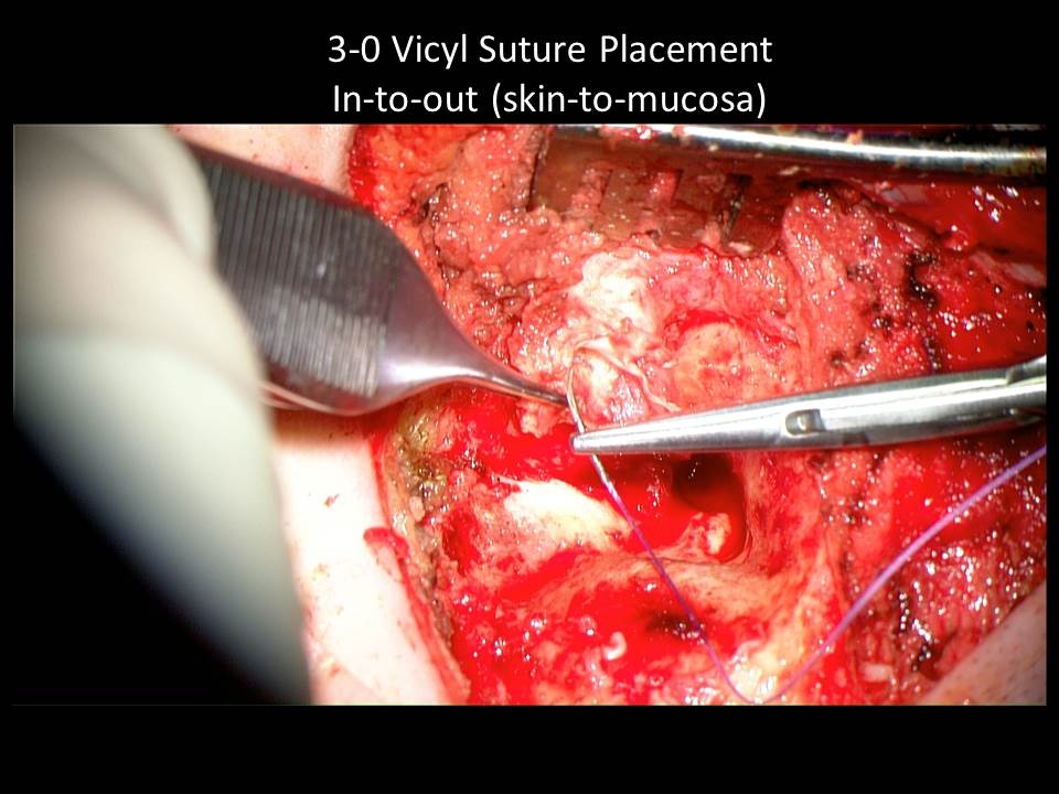 Subtotal Petrosectomy | Iowa Head and Neck Protocols - Carver College ...