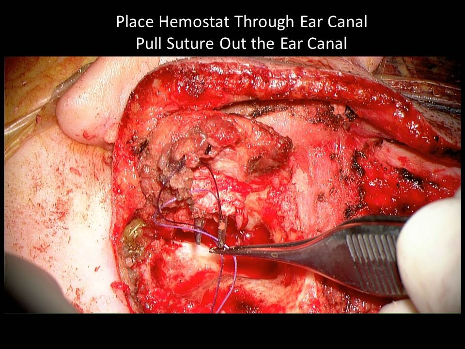 Subtotal Petrosectomy | Iowa Head and Neck Protocols - Carver College ...