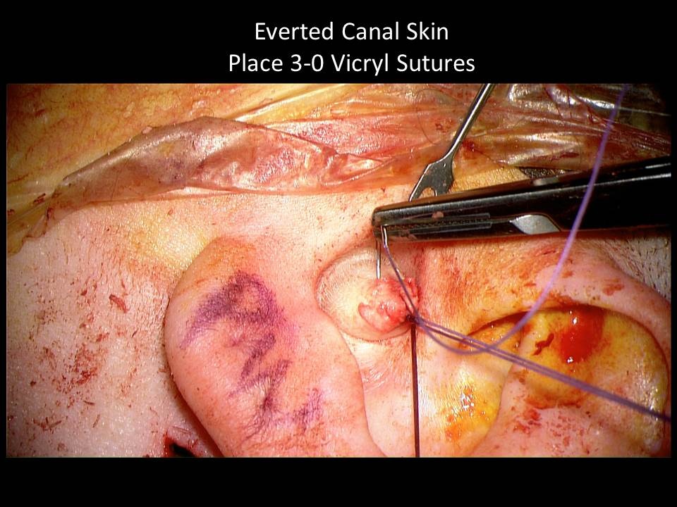 Subtotal Petrosectomy | Iowa Head and Neck Protocols - Carver College ...