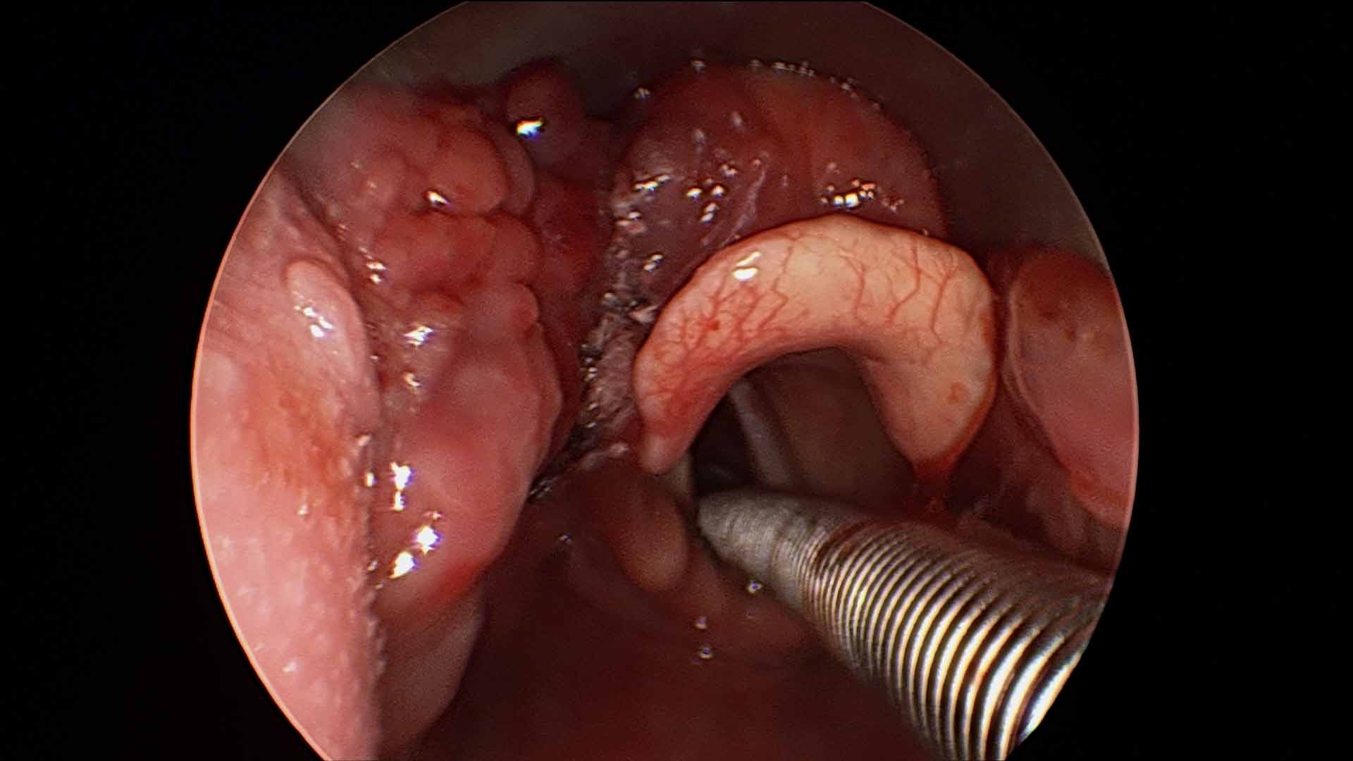 Vallecular Cyst | Iowa Head and Neck Protocols - Carver College of ...