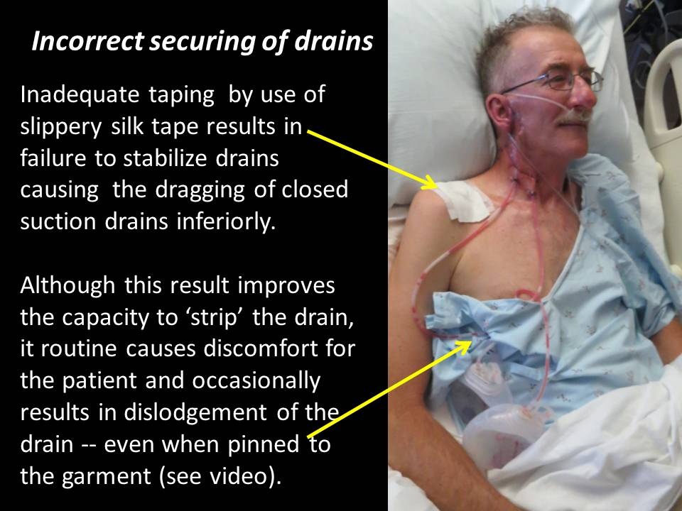 Closed Suction Drain Management - Securing the Drain | Iowa Head and ...