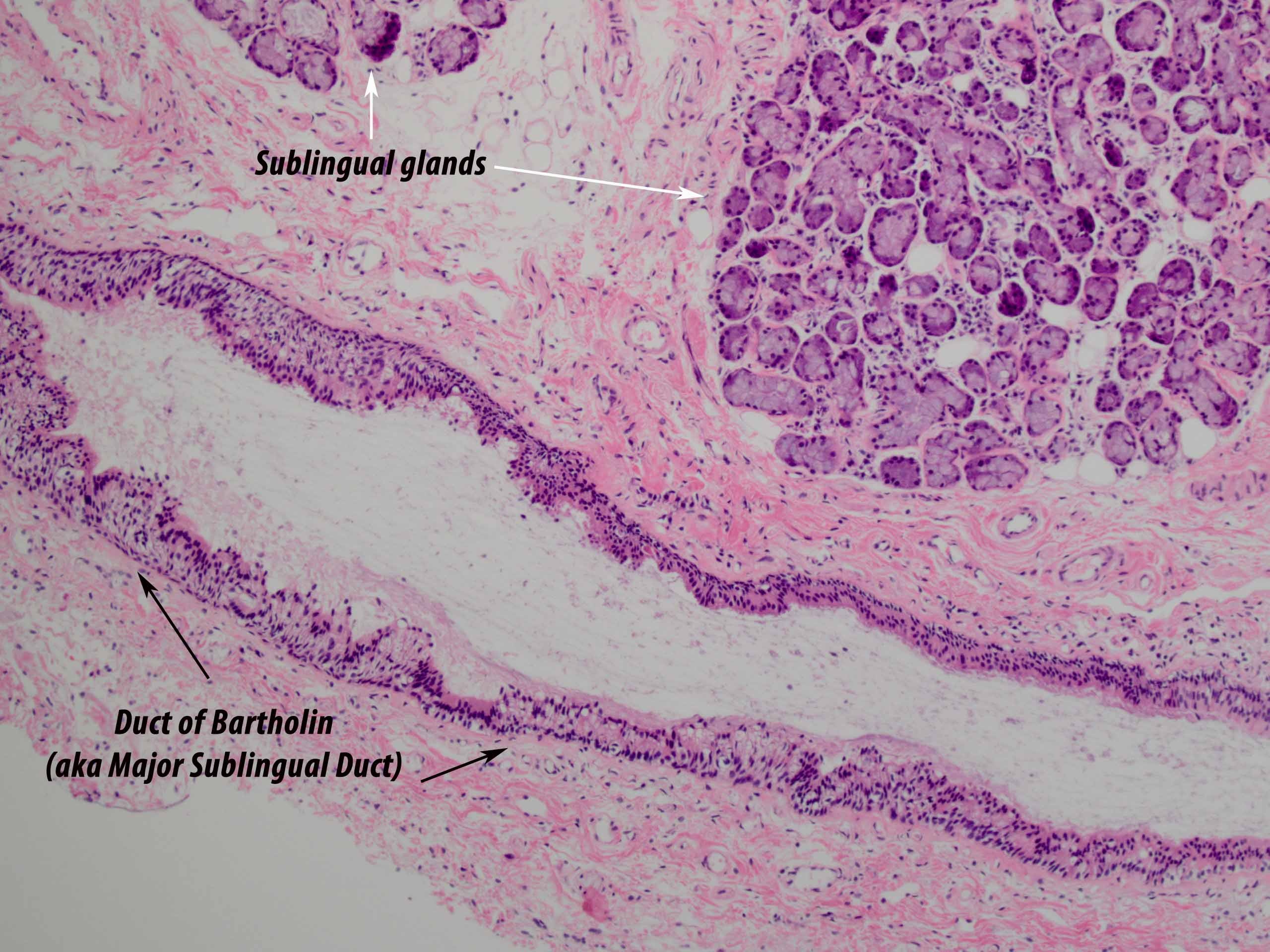 Salivary Stone Removal with Ductoplasty from Submandibular Gland | Iowa ...