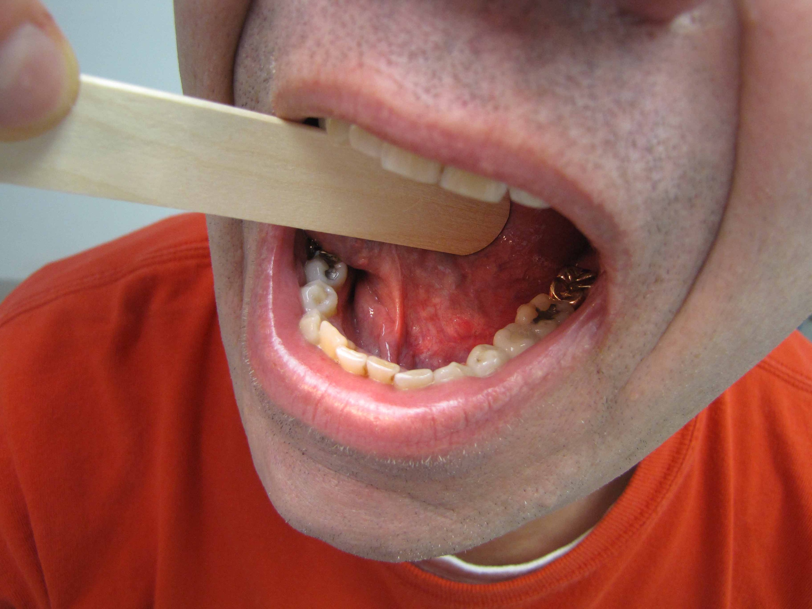Retained Submandibular Stone After Submandibular Gland Resection with ...