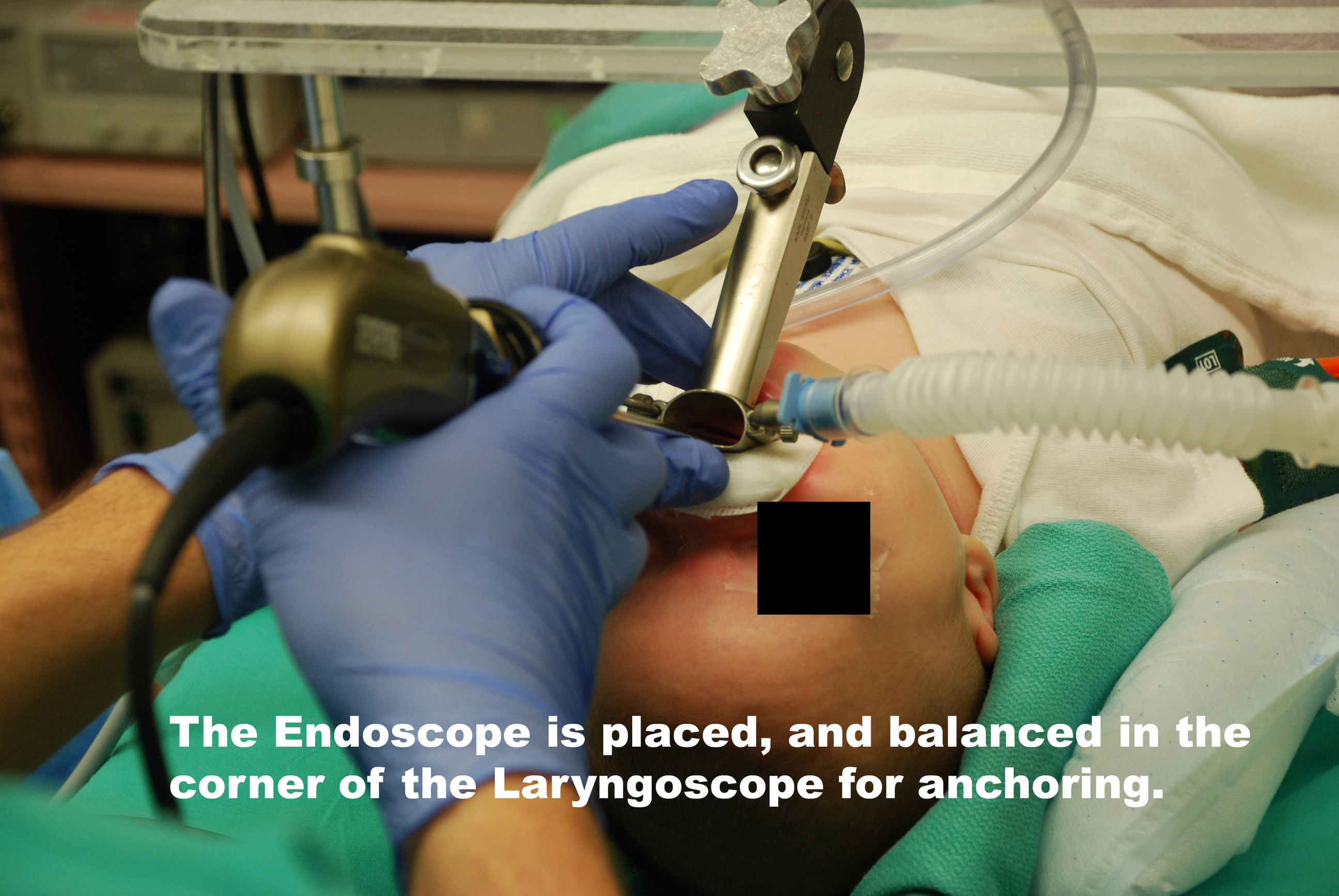 Pediatric Direct Laryngoscopy | Iowa Head and Neck Protocols - Carver ...