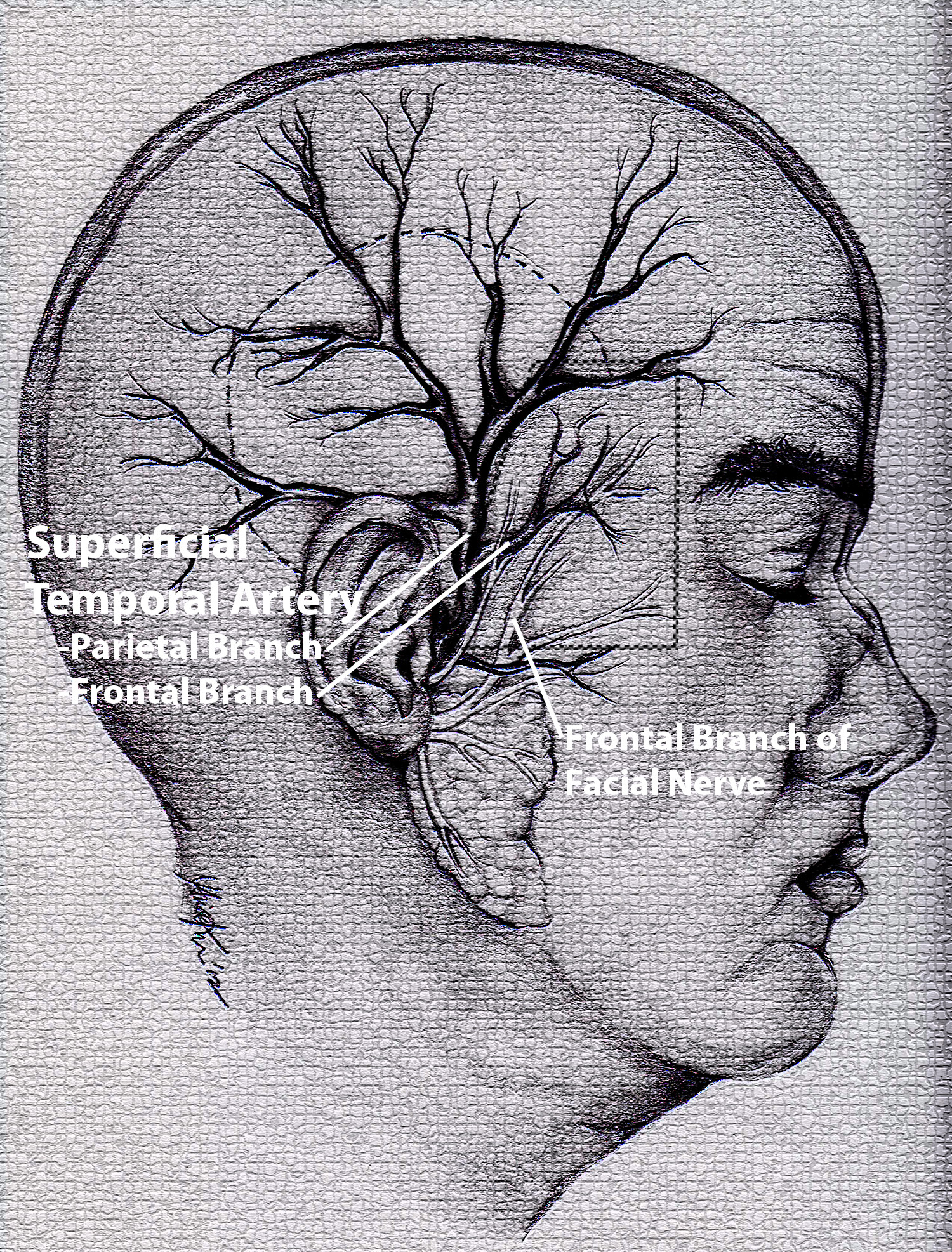 Temporal Arteritis (Giant Cell Arteritis) and Temporal Artery Biopsy ...