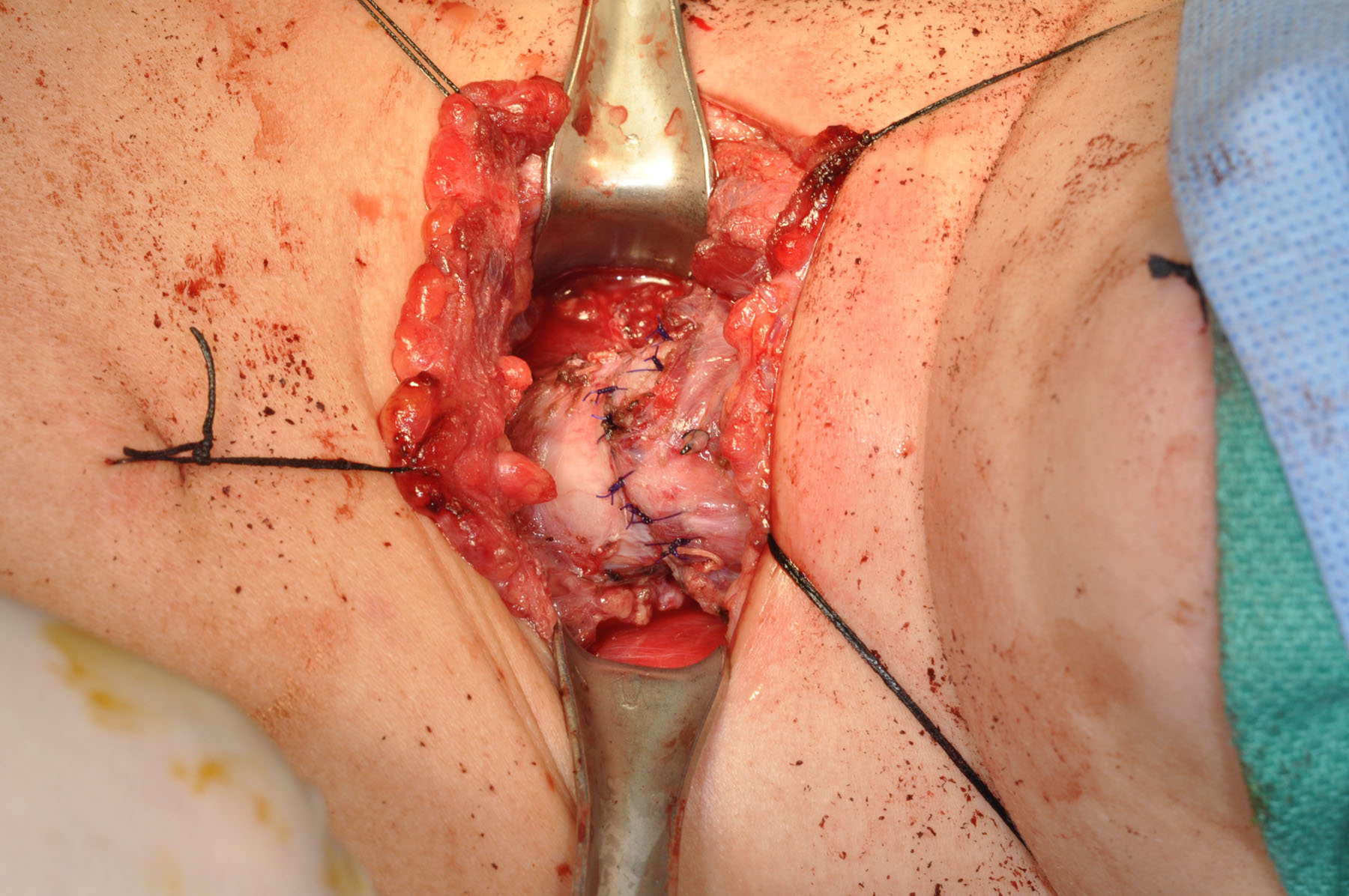 Tracheal Sleeve Resection with Suprahyoid and Infrahyoid Release | Iowa ...