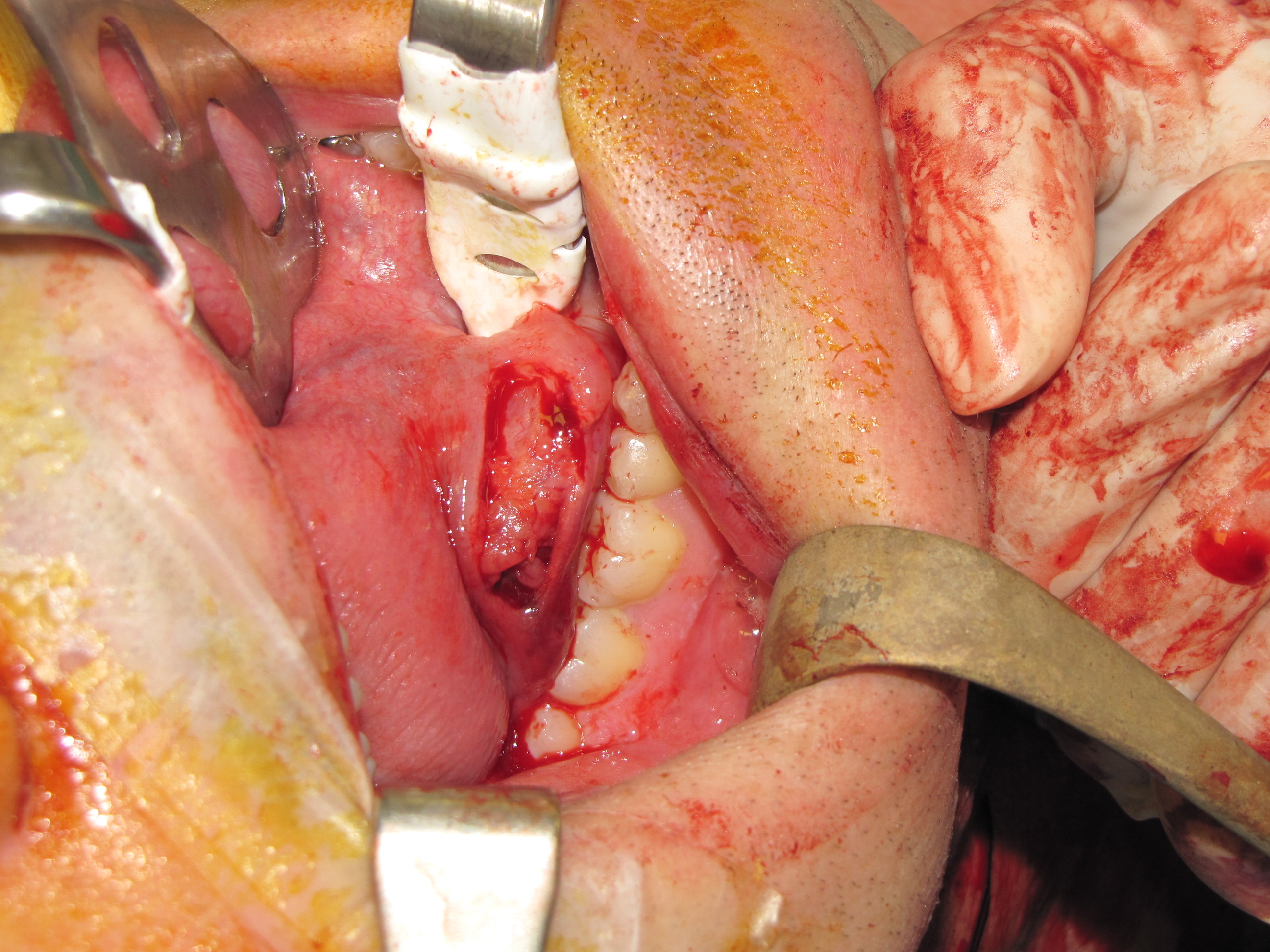 Plunging Ranula - Now Antiquated Treatment | Iowa Head and Neck ...