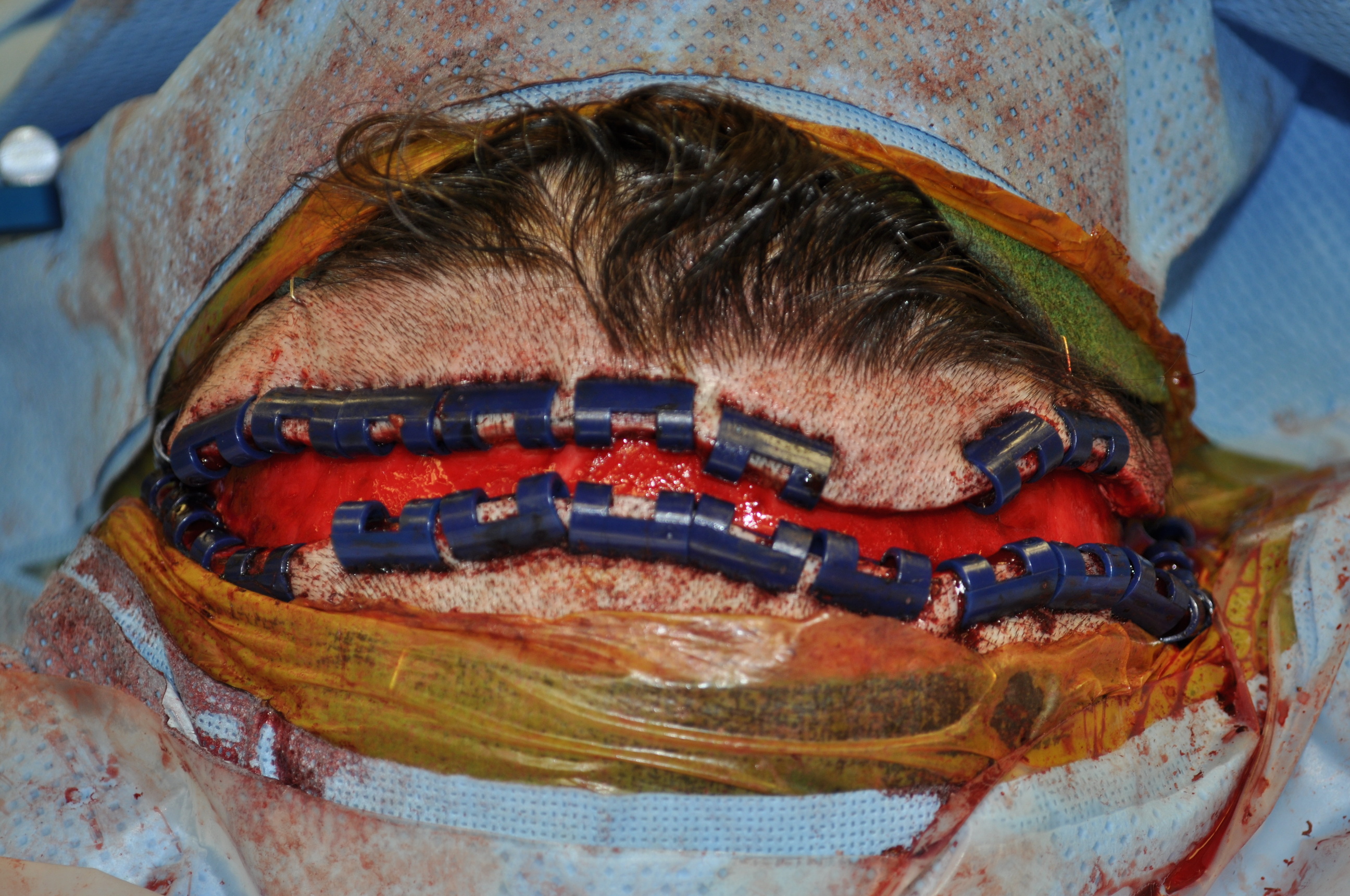 Anterior Pericranial and Galeofrontalis-Pericranial Flaps | Iowa Head ...