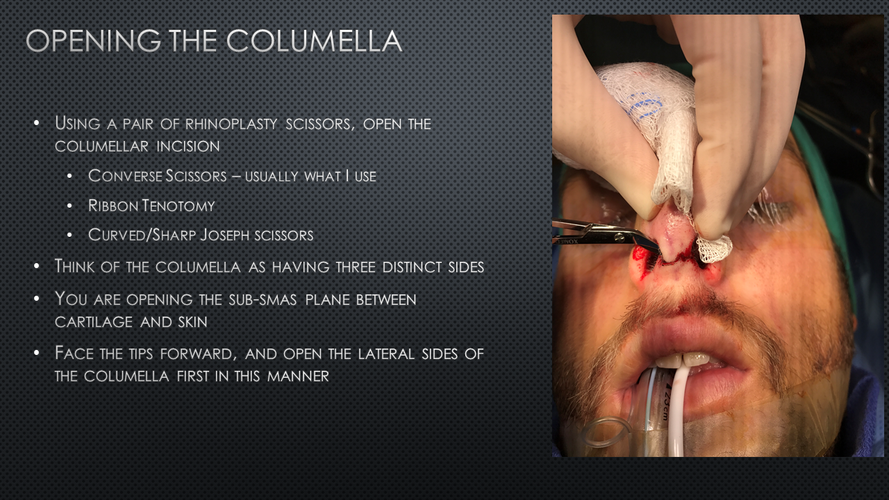 Open Septorhinoplasty - Surgical Demonstration (Rhinoplasty) | Iowa ...