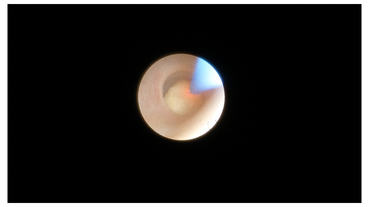 Laser Management of Submandibular Salivary Gland Stone (Sialolithiasis ...
